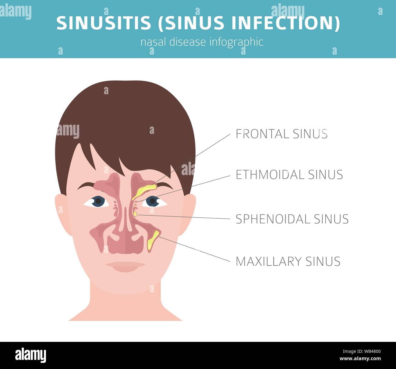 Sinusite frontale Banque d'images vectorielles - Alamy