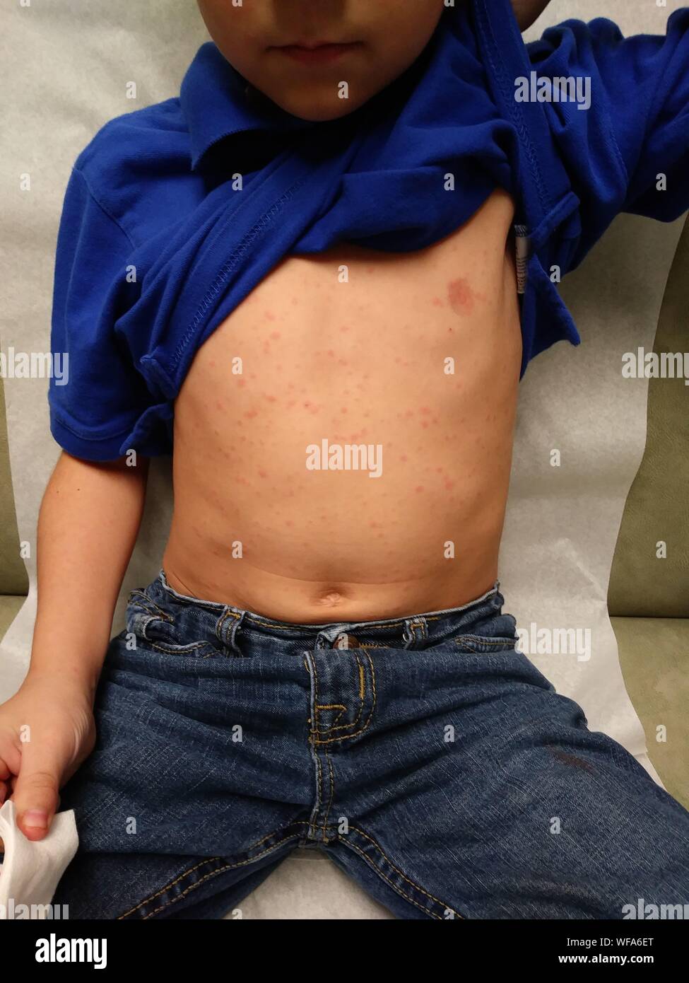 Skin desease Banque de photographies et d’images à haute résolution - Alamy