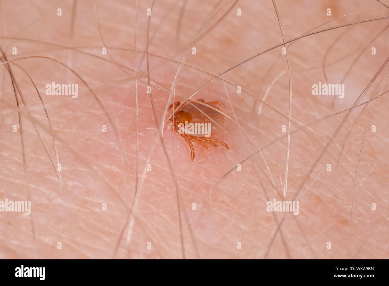Tique Humain Banque d'image et photos - Alamy