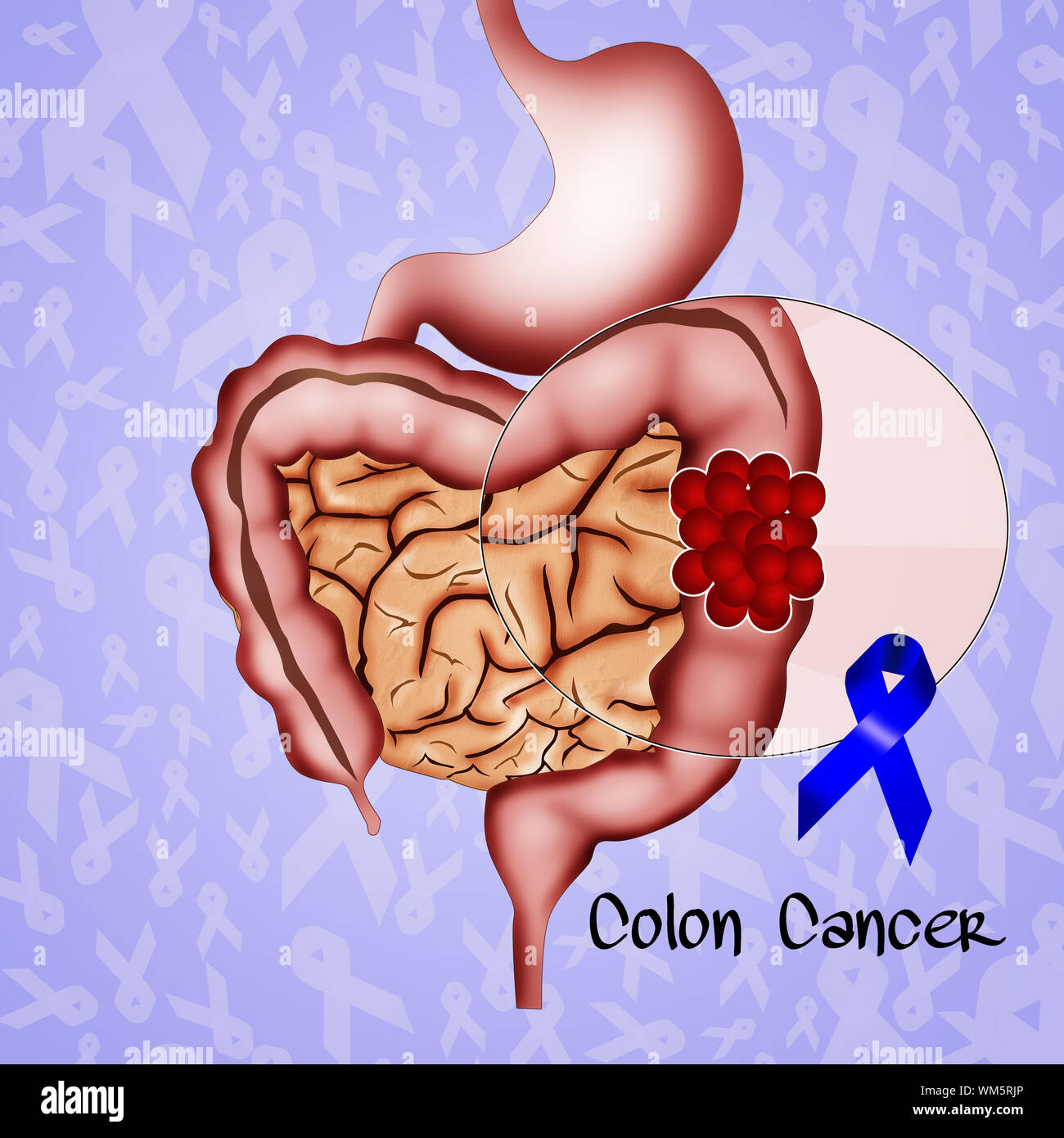 Cancer de l'intestin humain Banque de photographies et d’images à haute ...