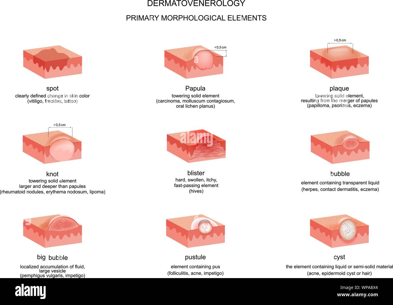 Epidermoid cyst Banque d'images vectorielles - Alamy