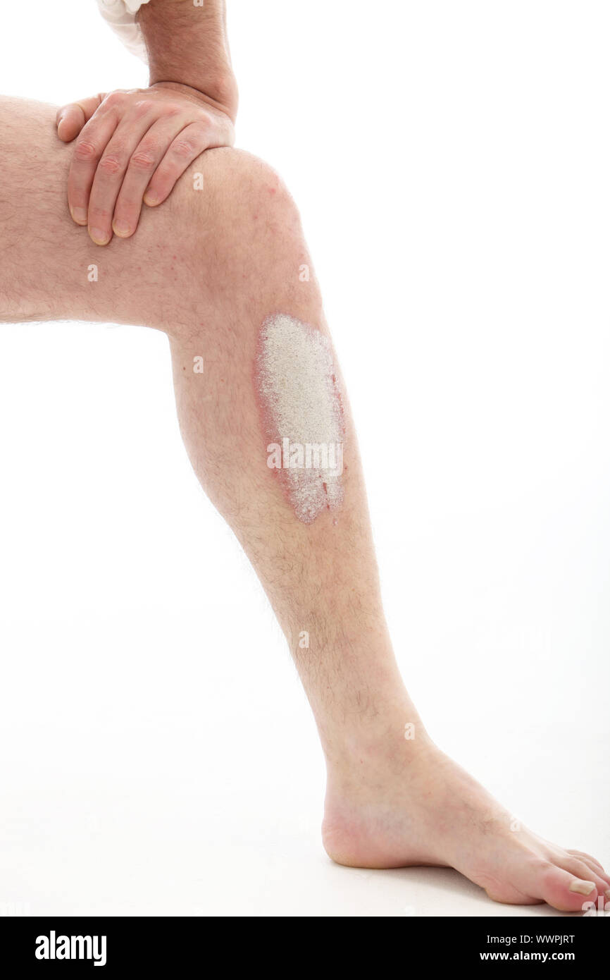 Peau de psoriasis jambe Banque de photographies et d’images à haute ...