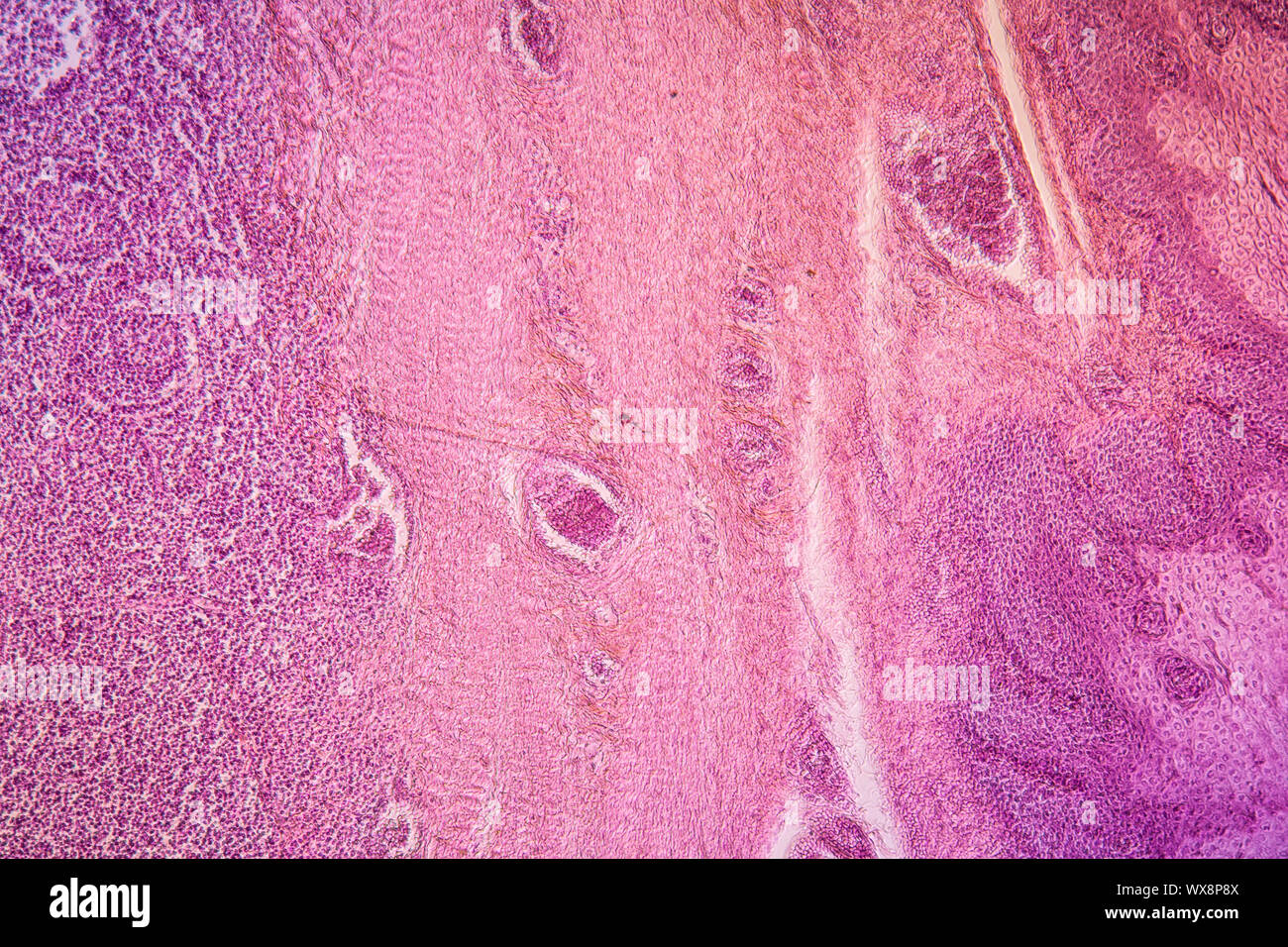 Tonsils tonsillitis Banque de photographies et d’images à haute ...