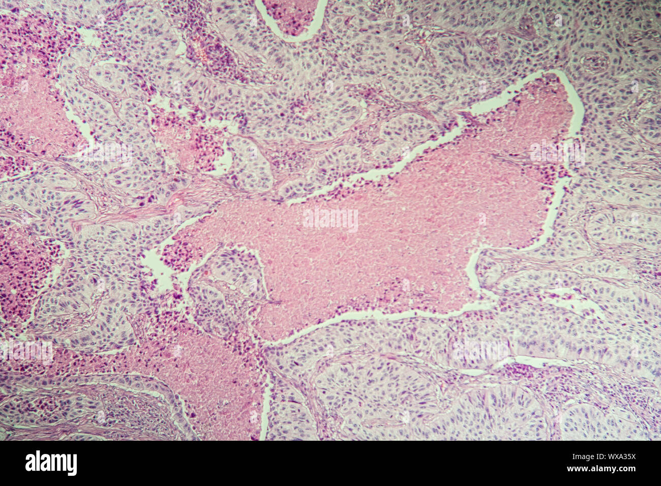 Carcinome épidermoïde Banque de photographies et d’images à haute ...