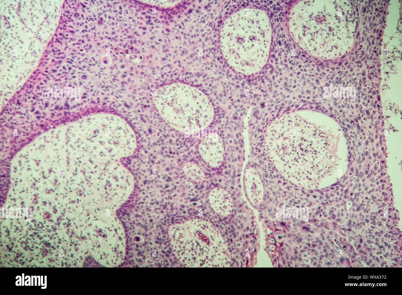 Maladie de bowens maladie Banque de photographies et d’images à haute ...