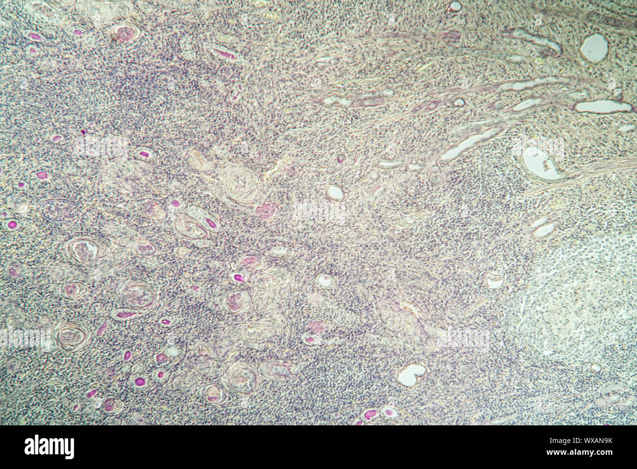 Hydronephrose renal Banque de photographies et d’images à haute ...