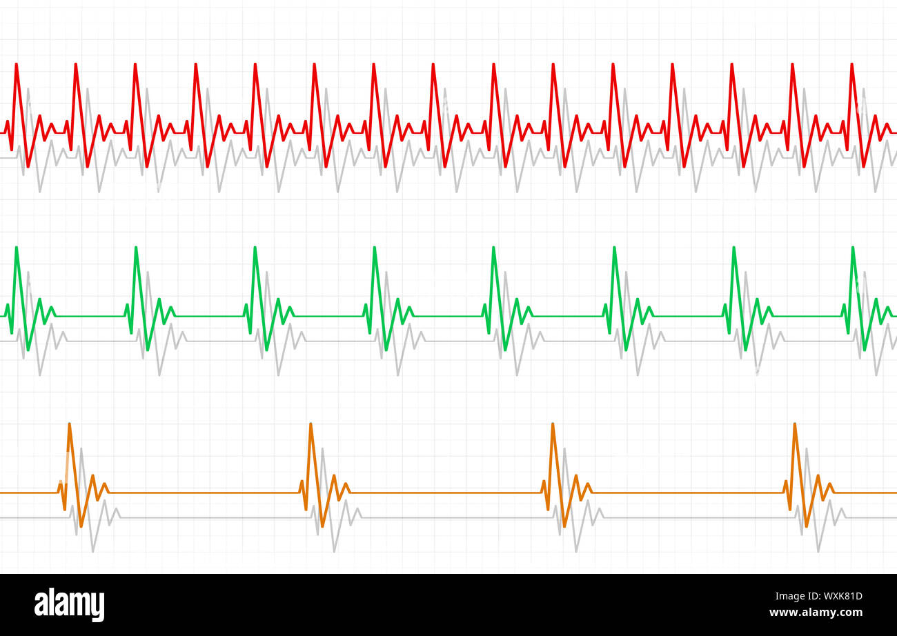Normal ecg Banque de photographies et d’images à haute résolution - Alamy
