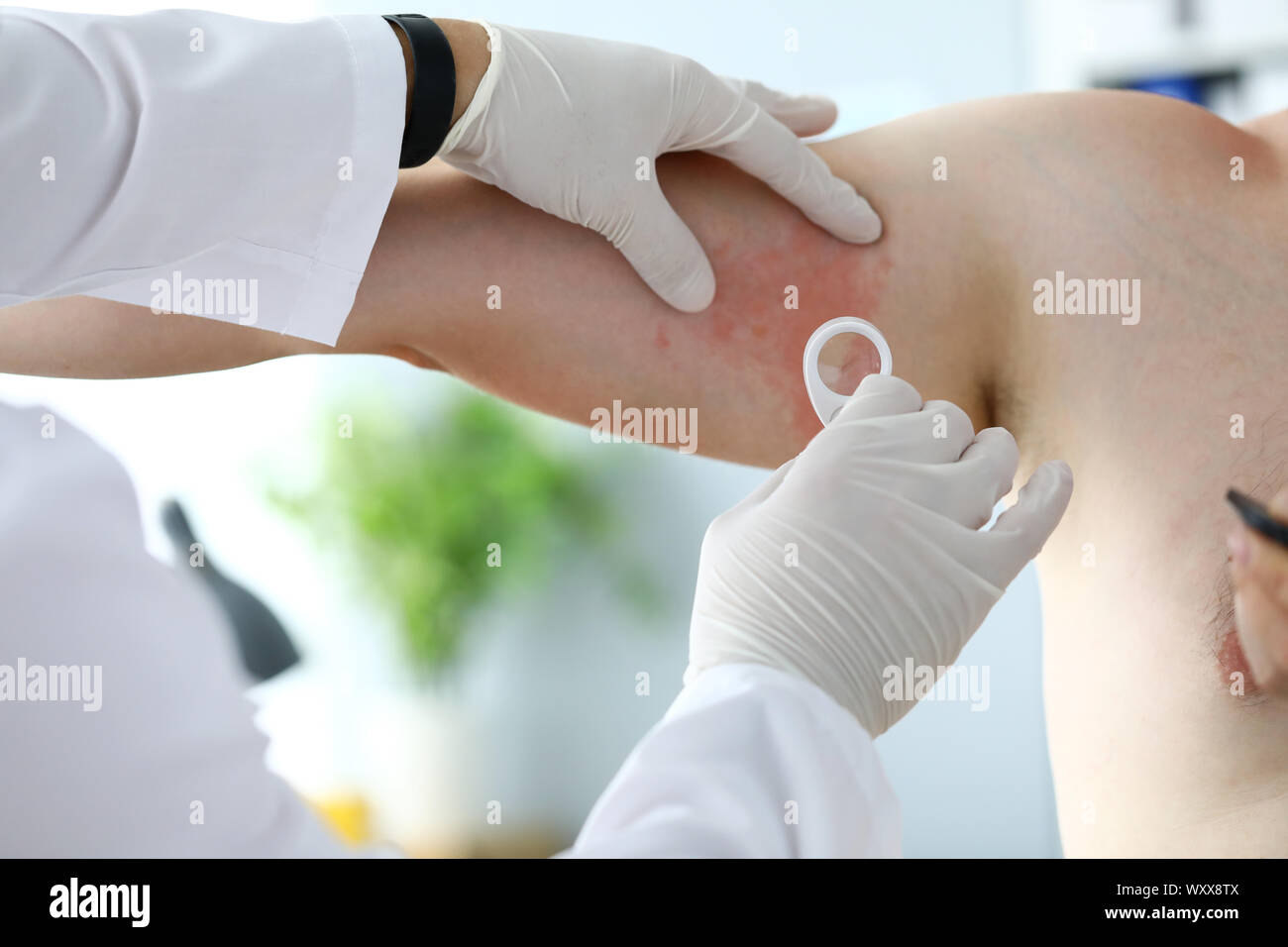 Maladie de la peau affection des mains dermatologie Banque de ...
