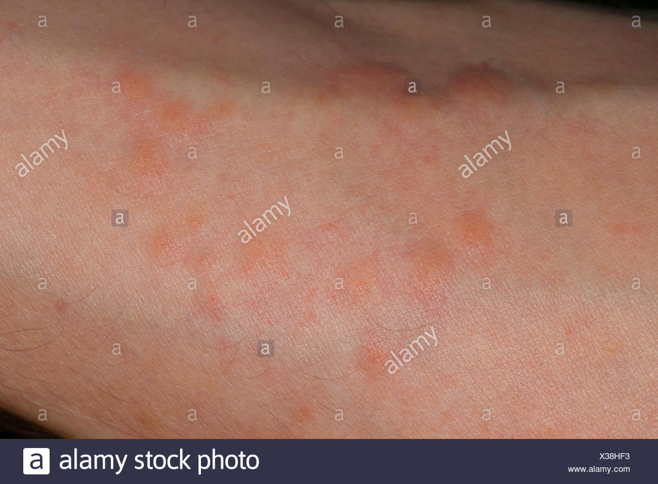 Dermatite Allergique De Contact Banque d'image et photos - Alamy