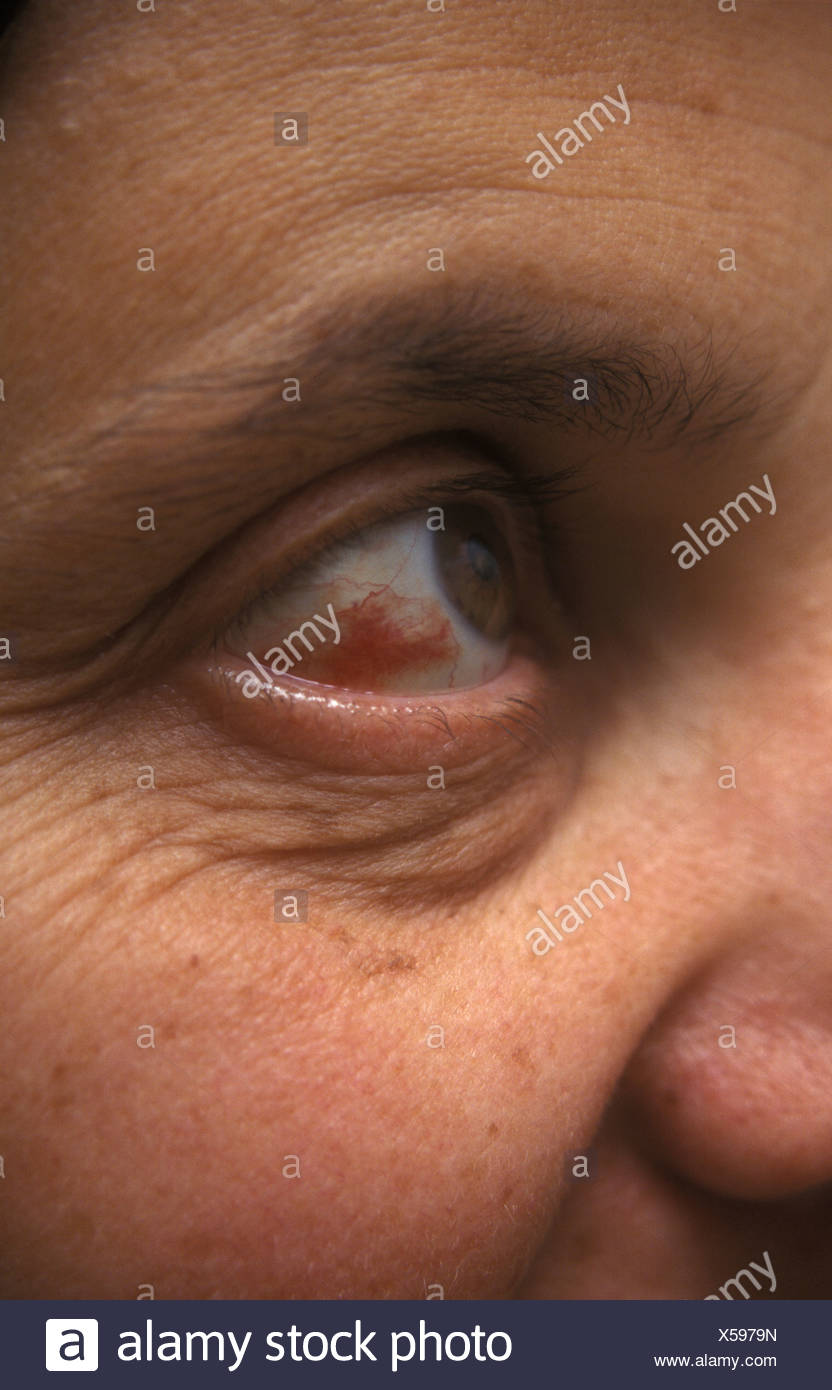 Vaisseau Sanguin Banque d'image et photos - Alamy