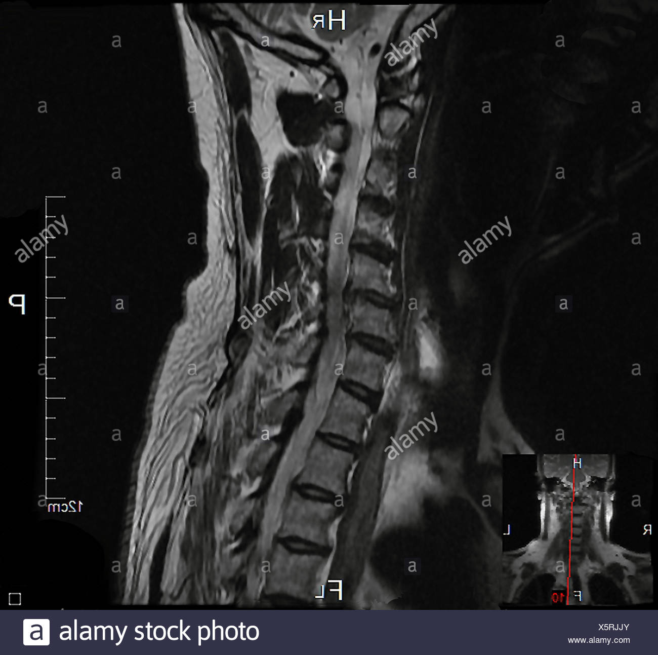 Irm De La Colonne Cervicale Banque d'image et photos - Alamy