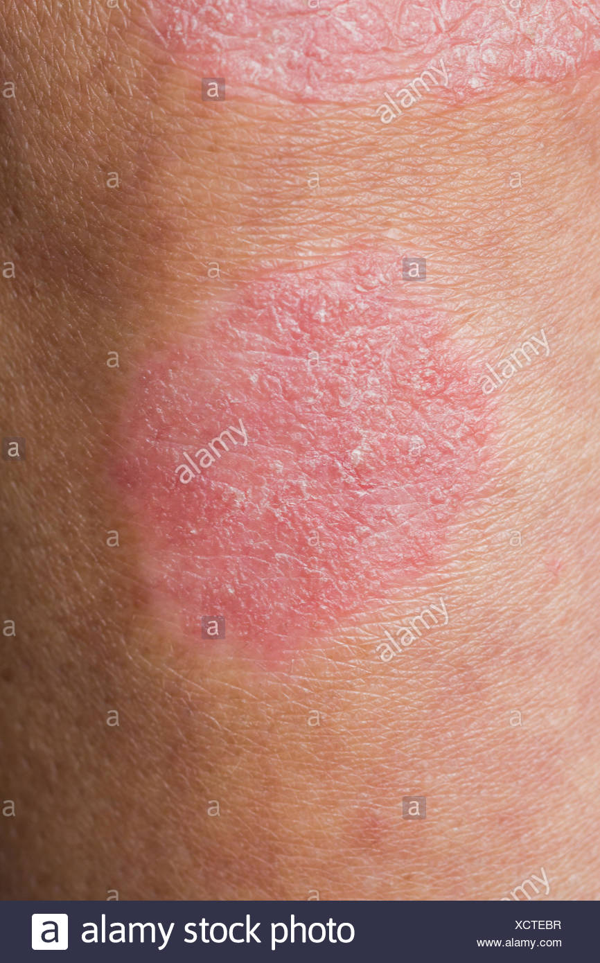 Psoriasis Skin Dermatology Banque d'image et photos - Alamy
