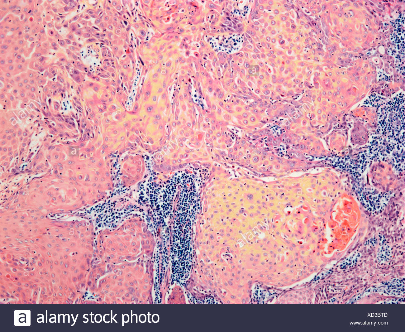Cancer De La Langue Banque d'image et photos - Alamy