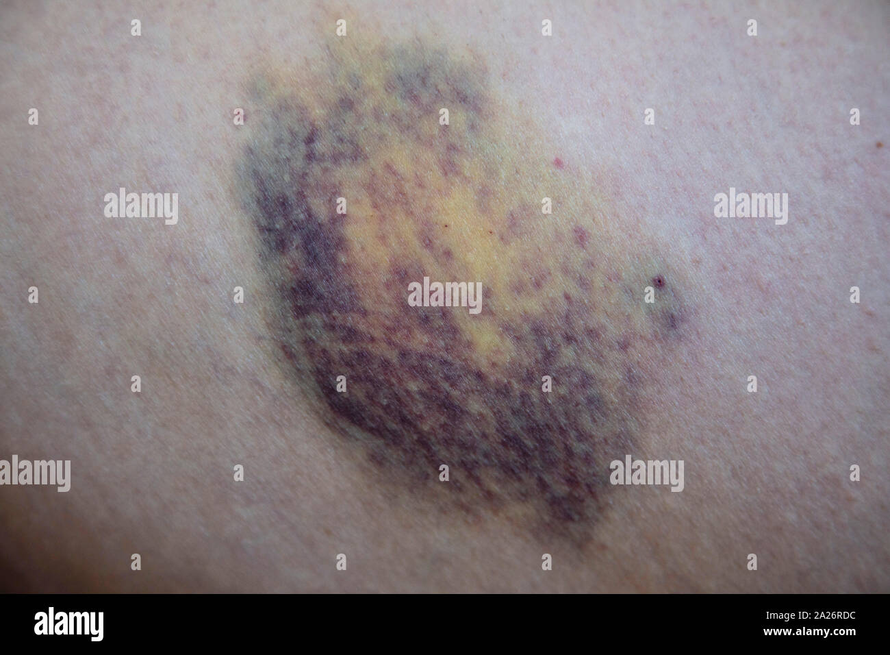 Bruise at a leg immagini e fotografie stock ad alta risoluzione - Alamy