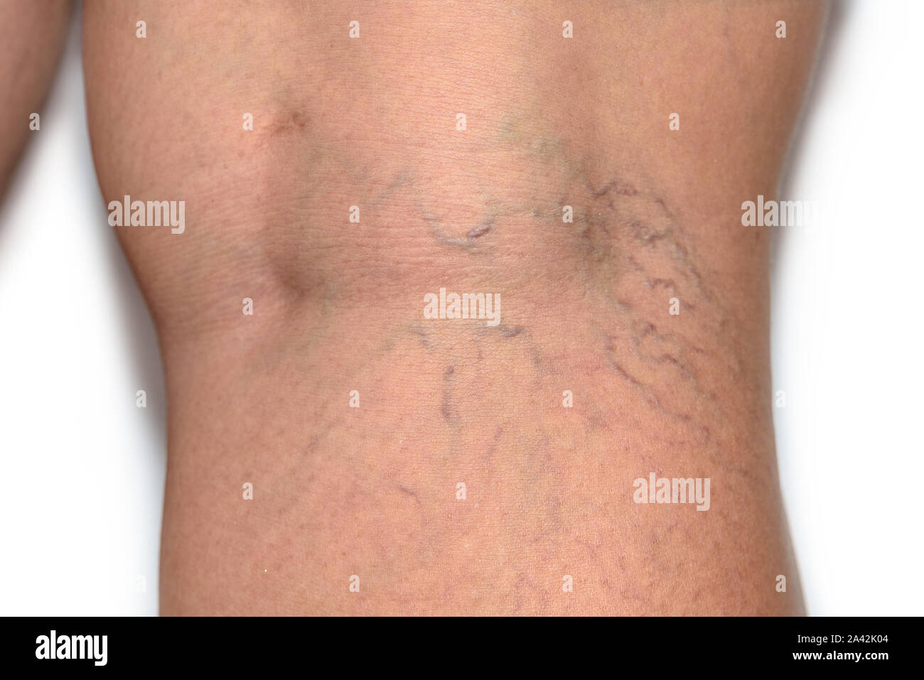 Trombosi delle vene delle gambe immagini e fotografie stock ad alta ...