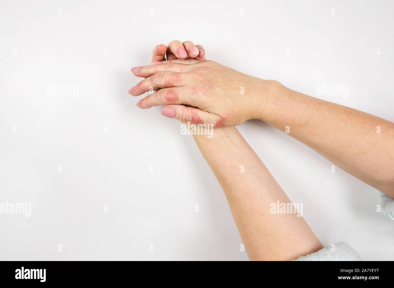 Dermatite alle mani immagini e fotografie stock ad alta risoluzione - Alamy