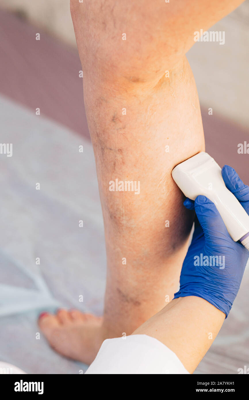 Trombosi delle vene delle gambe immagini e fotografie stock ad alta ...