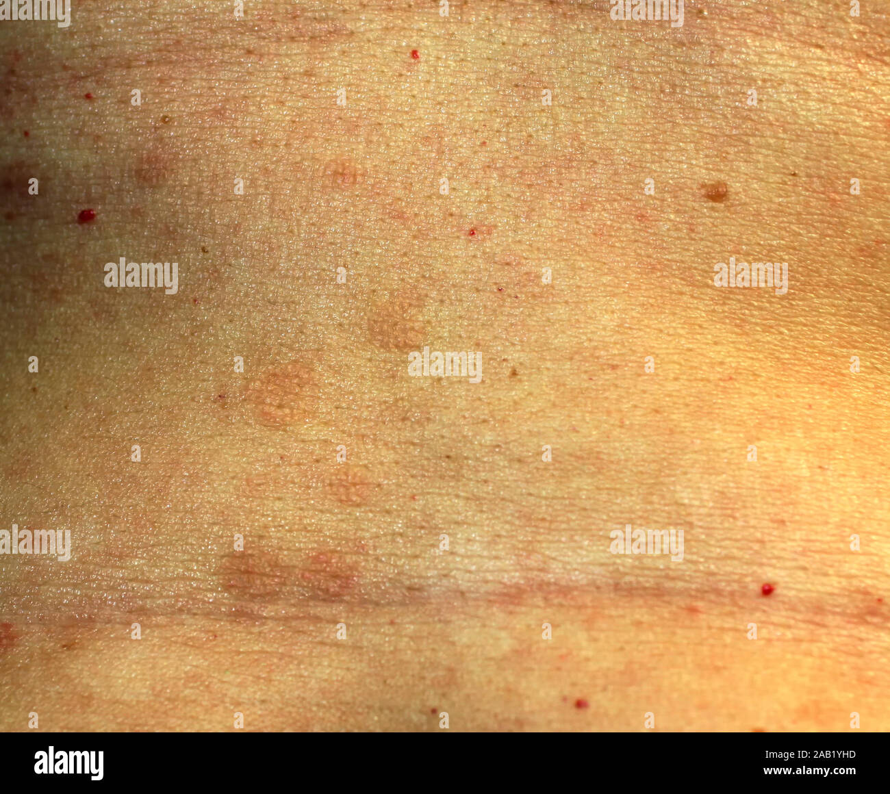 Pityriasis rosea immagini e fotografie stock ad alta risoluzione - Alamy