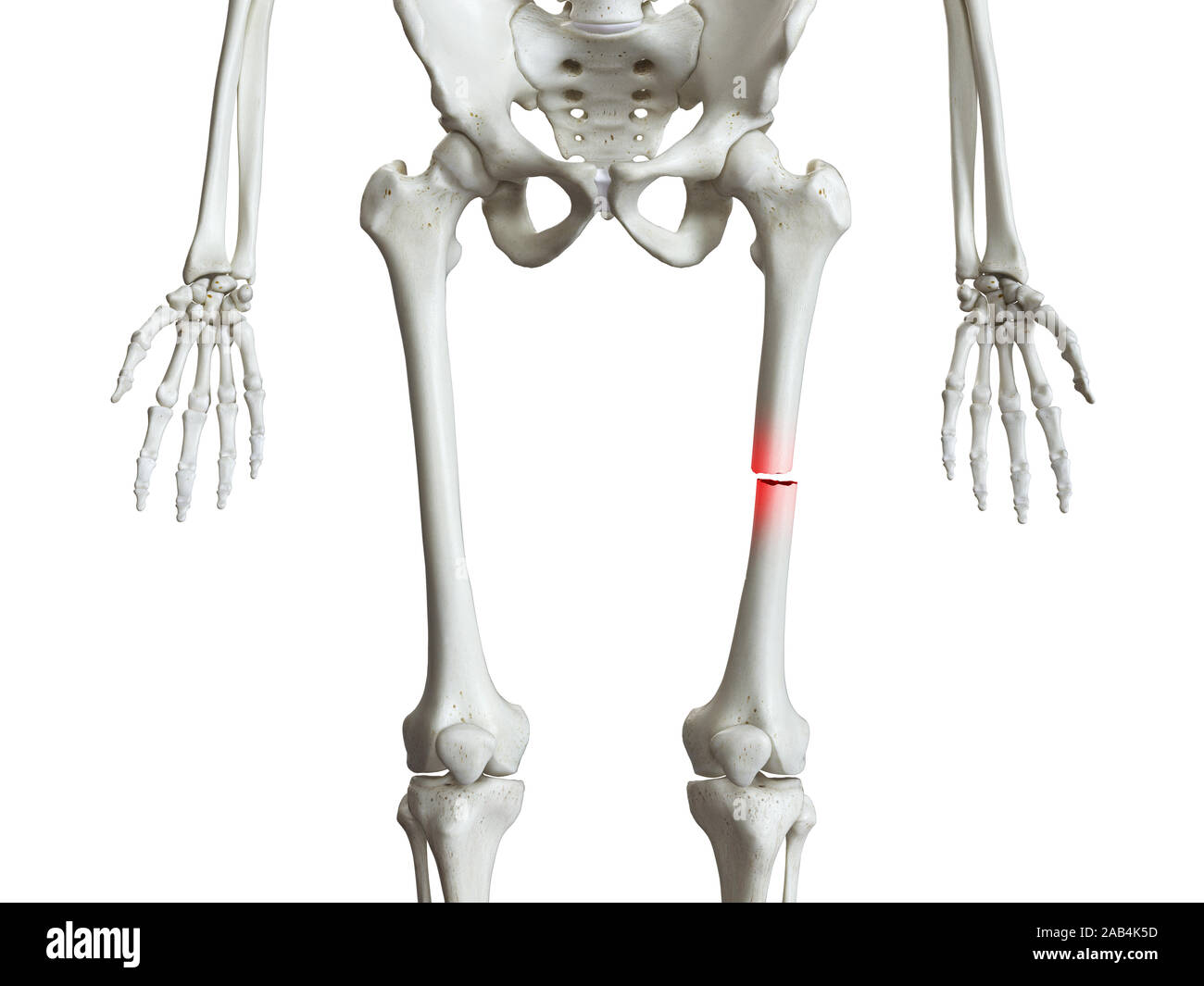 Femore rotto immagini e fotografie stock ad alta risoluzione - Alamy