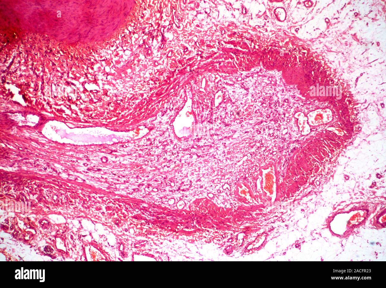 Di coagulo di sangue, micrografia di luce. Trombo (coagulo di sangue ...