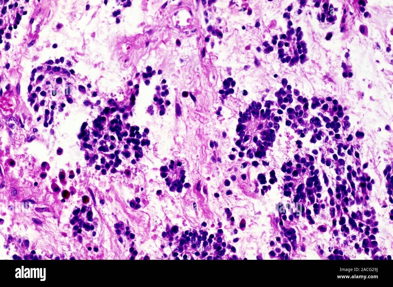 Il neuroblastoma. Micrografia di luce di una sezione attraverso un ...