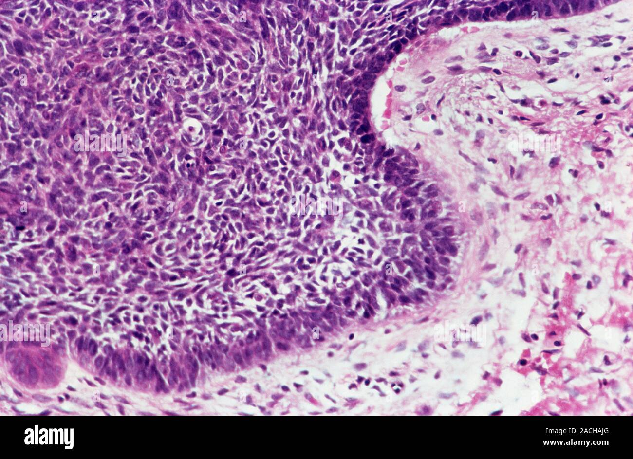 Il cancro della pelle. Micrografia di luce di una sezione attraverso la ...