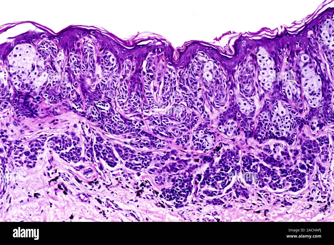 Benigna mole. Micrografia di luce di una sezione attraverso un composto ...