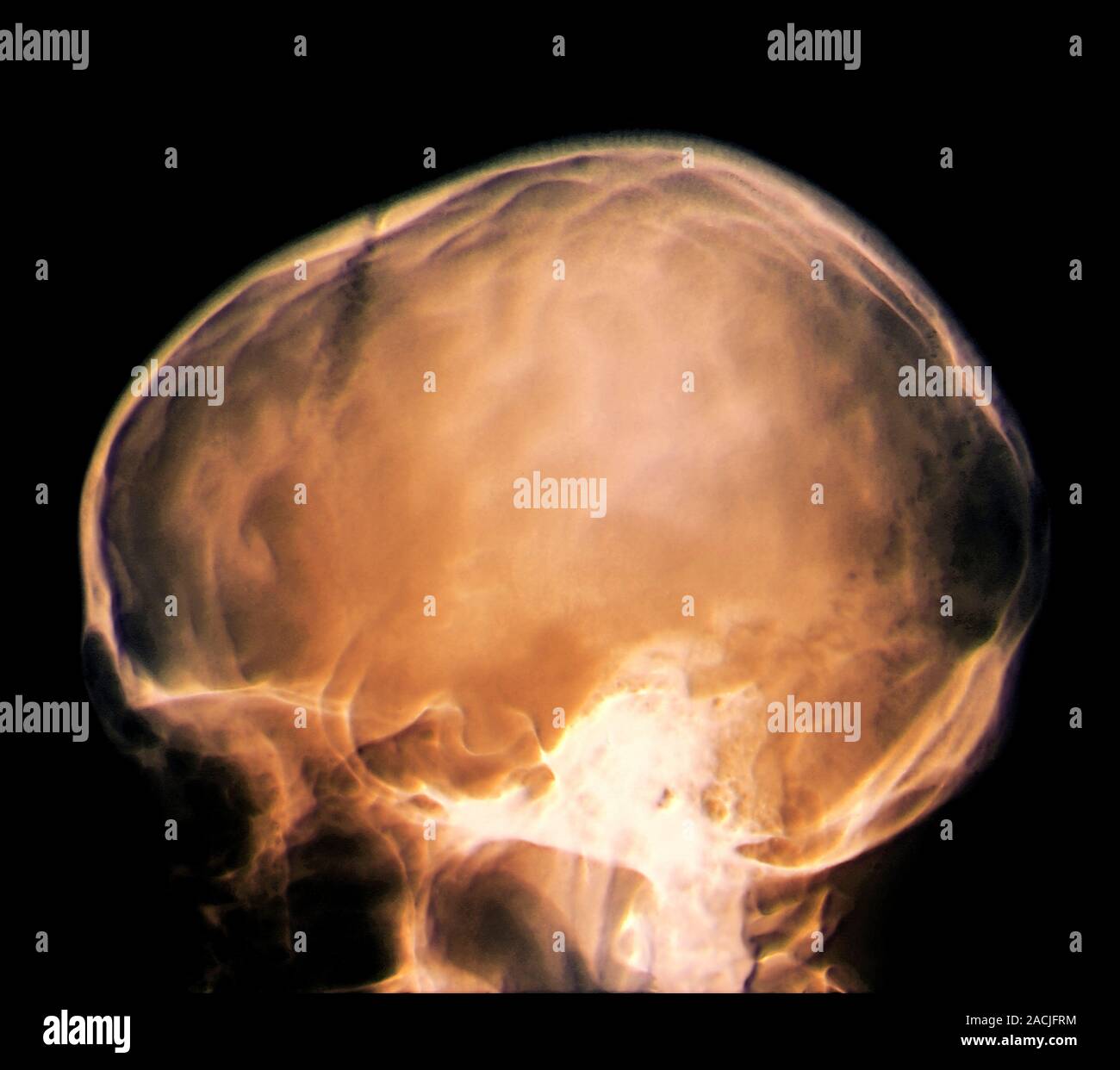 Colorato X-ray (vista laterale) del cranio in un 28 anno vecchio ...