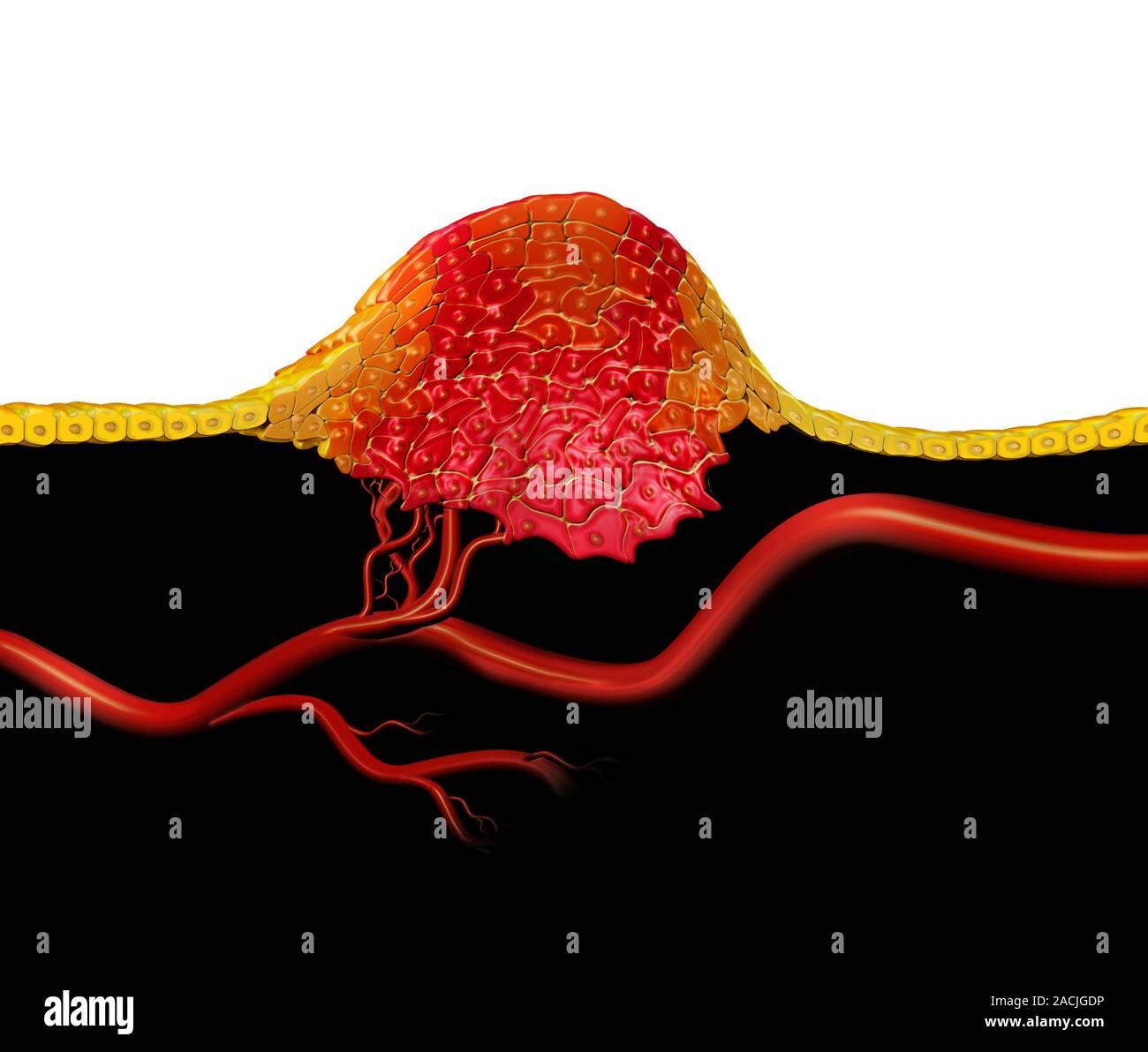 Tumore. Computer grafica di un tumore cresce in pelle e mostra i vasi ...