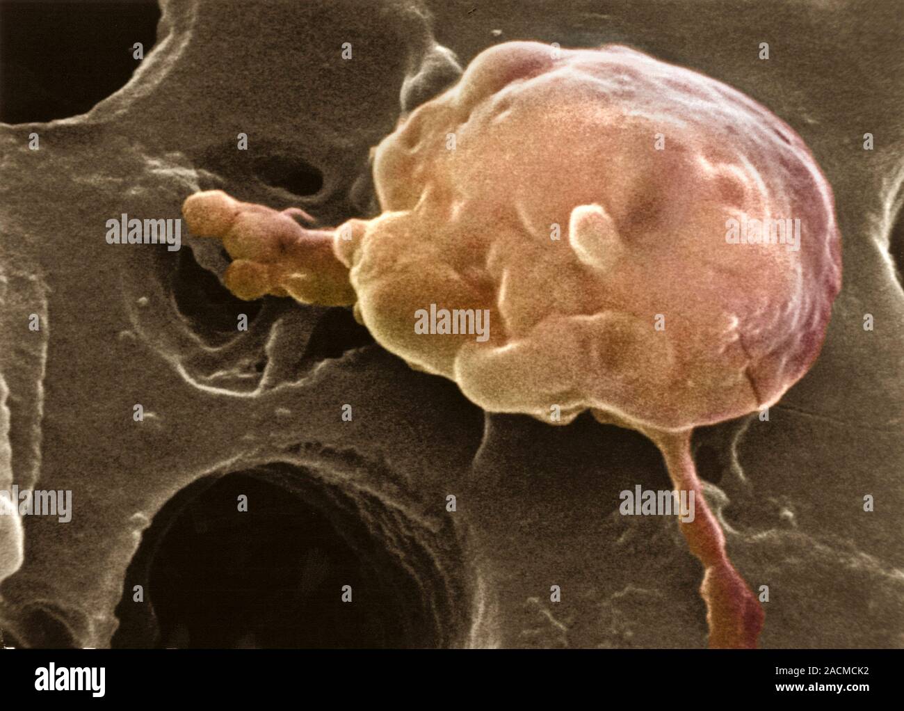 La cellula di cancro attaccato dai macrofagi. Color scanning electron ...