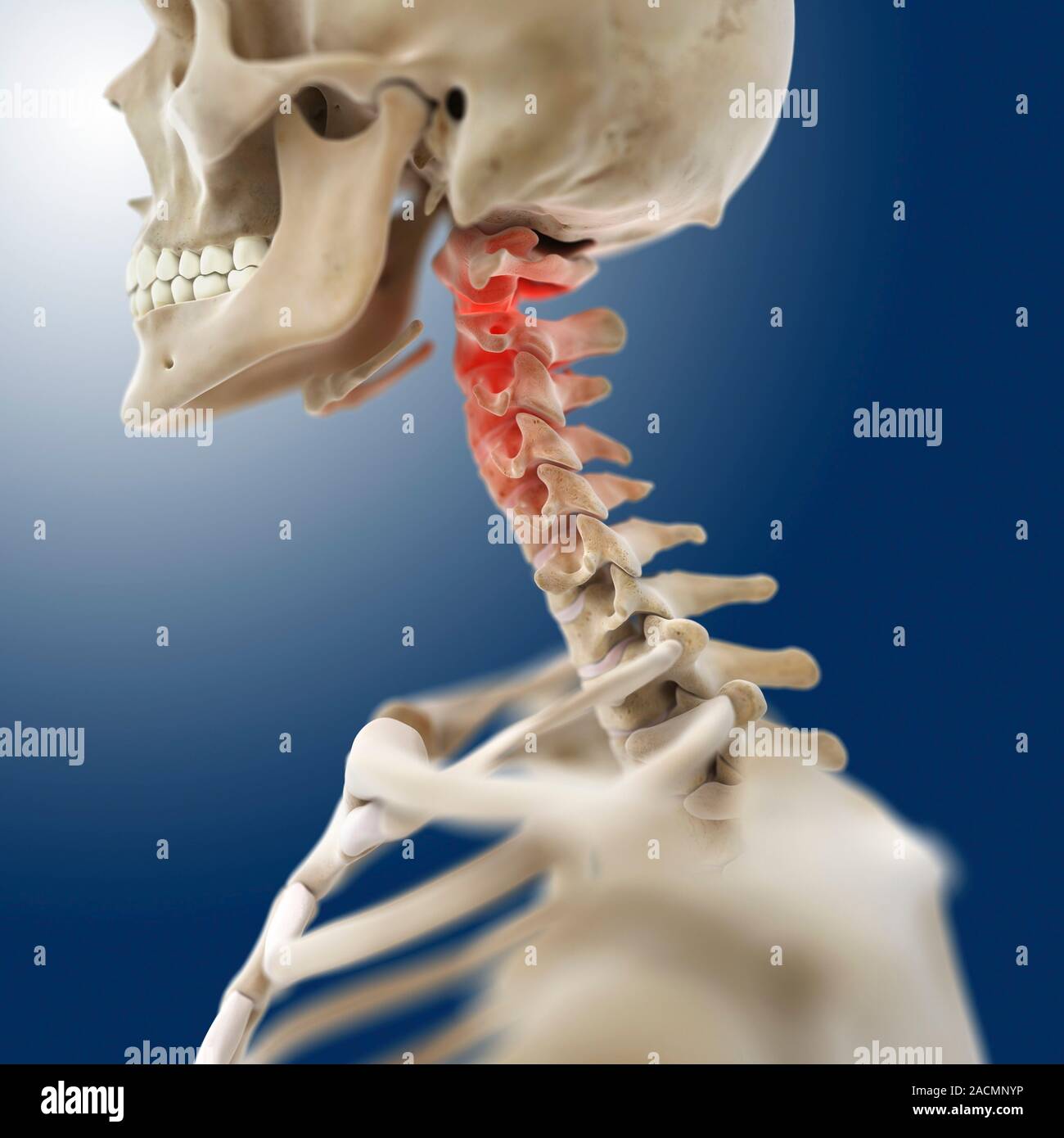 Dolore al collo, concettuale computer grafica. Infiammazione (rosso) nella colonna cervicale ...