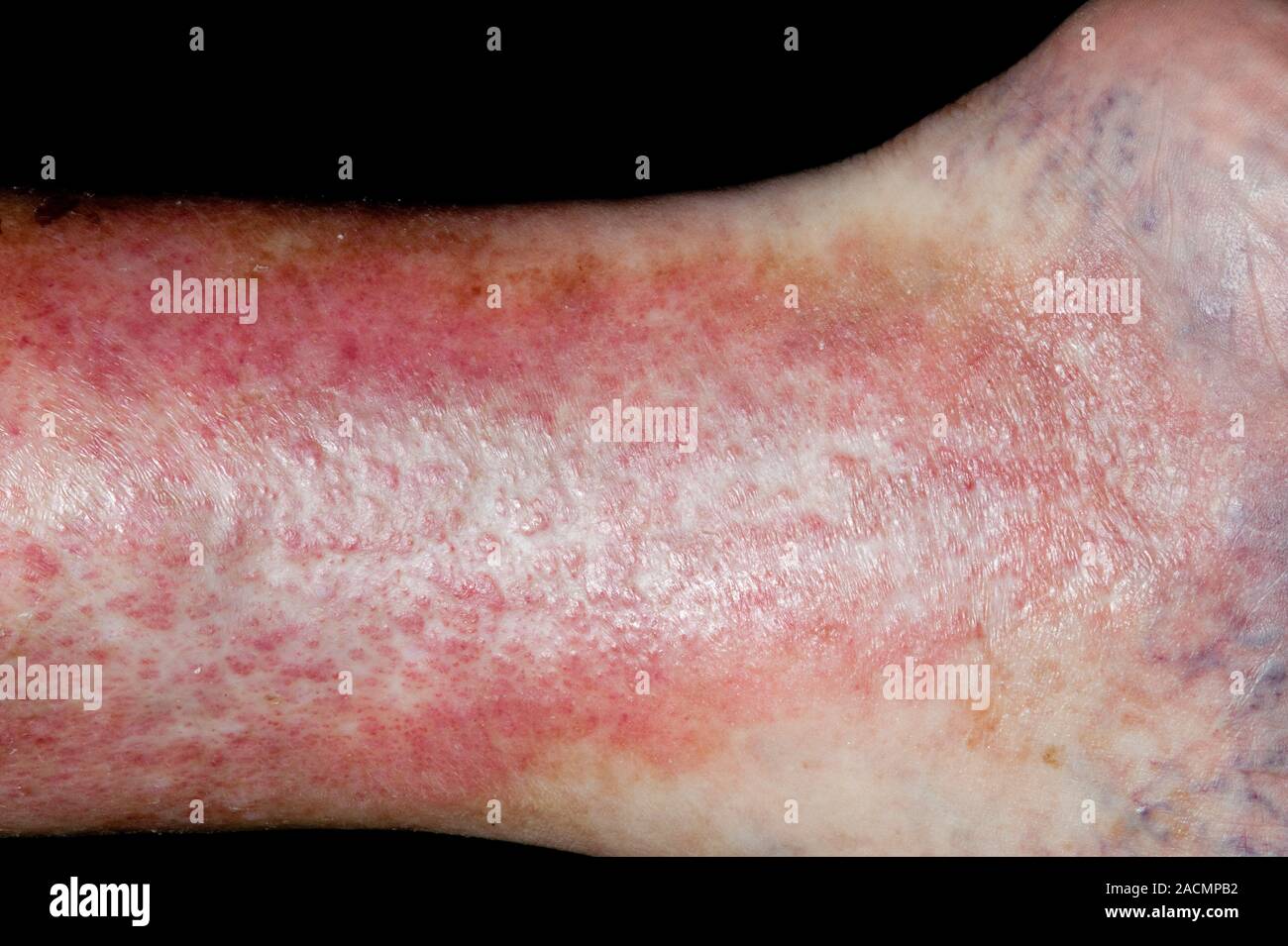 Close-up di trattati eczema varicose sulla parte inferiore della gamba ...