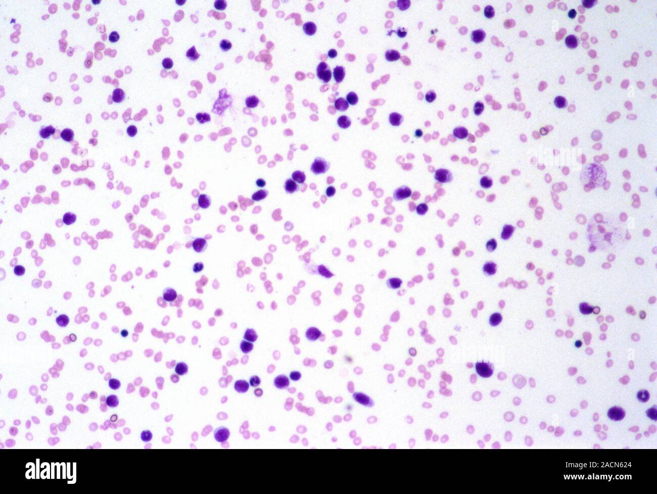 Acuta leucemia linfocitica. Micrografia luce di uno striscio di sangue ...