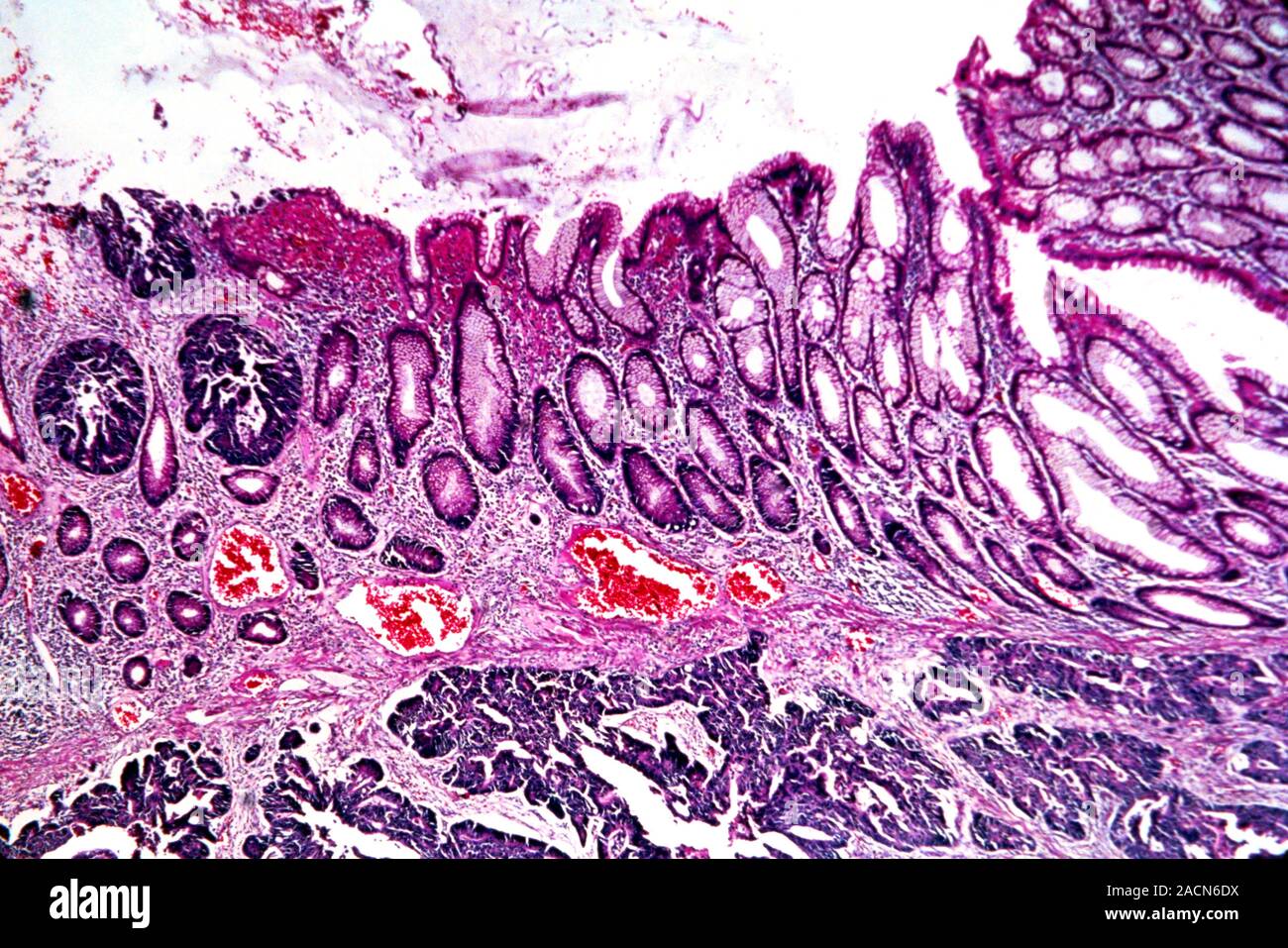 Il cancro del colon. Micrografia di luce di una sezione attraverso il ...