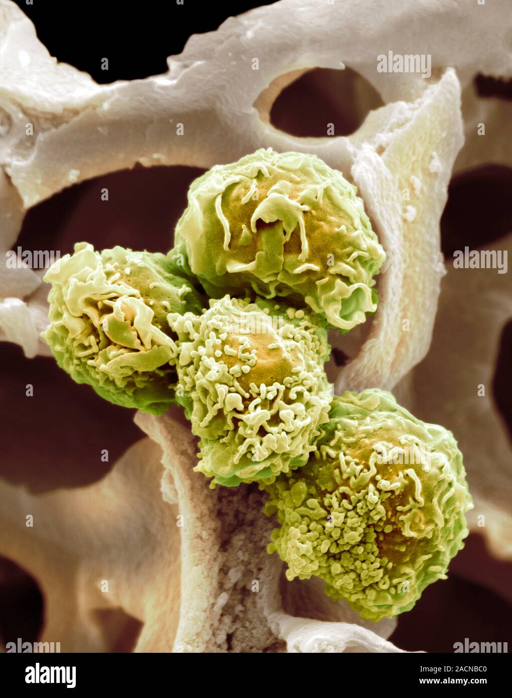 Le cellule HeLa. Color scanning electron microfotografia (SEM) di ...