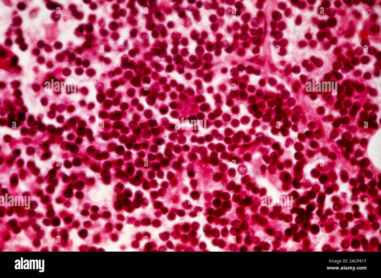 Leucemia linfatica cronica. Micrografia luce di cellule del sangue dal ...