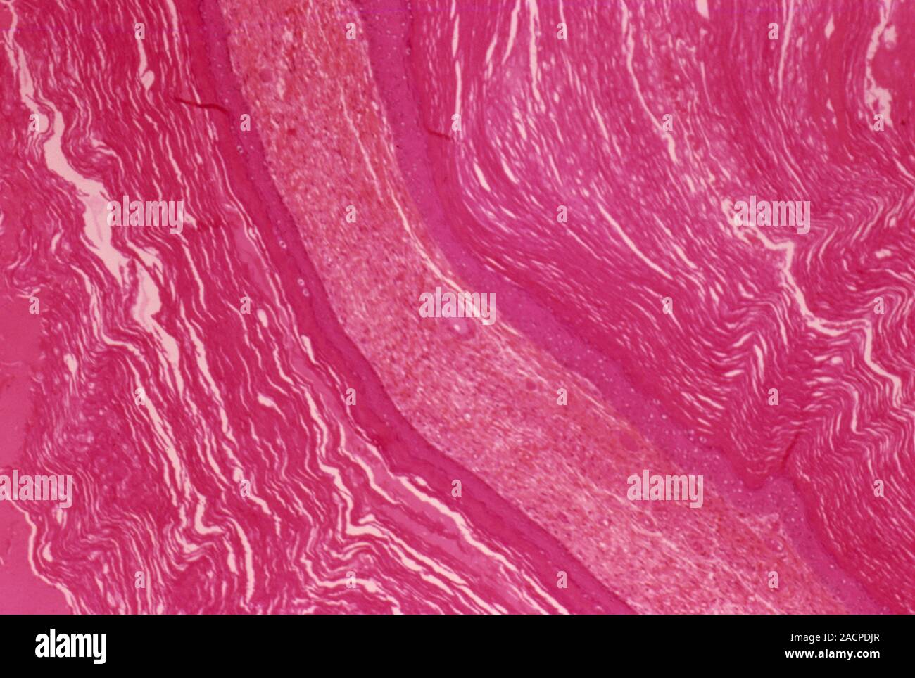 Dermoid ciste ovarica. Micrografia di luce di una sezione attraverso un ...