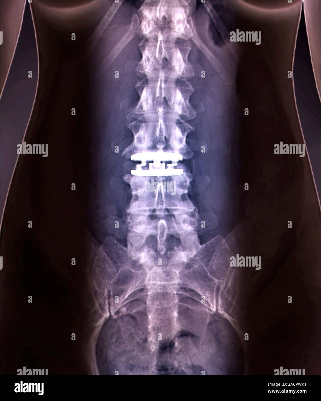 Artificiale disco spinale. Colorato X-ray della colonna vertebrale di ...