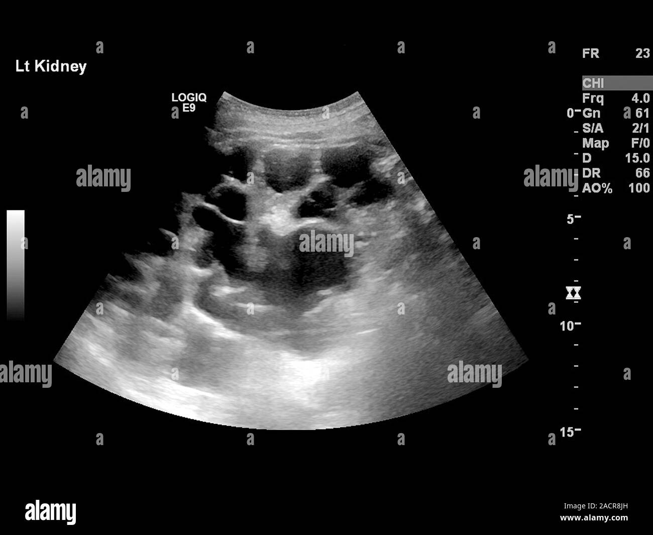 Policistica Renale. Scansione a ultrasuoni del rene di un 82 enne ...