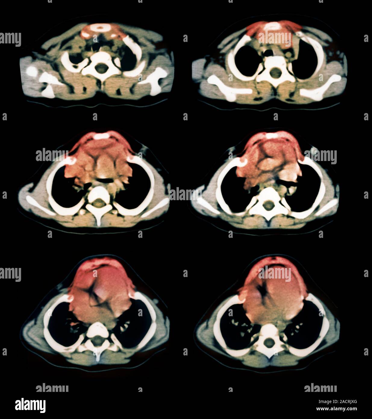 Jeune sindrome. Colorato la tomografia computerizzata (CT) scansioni ...