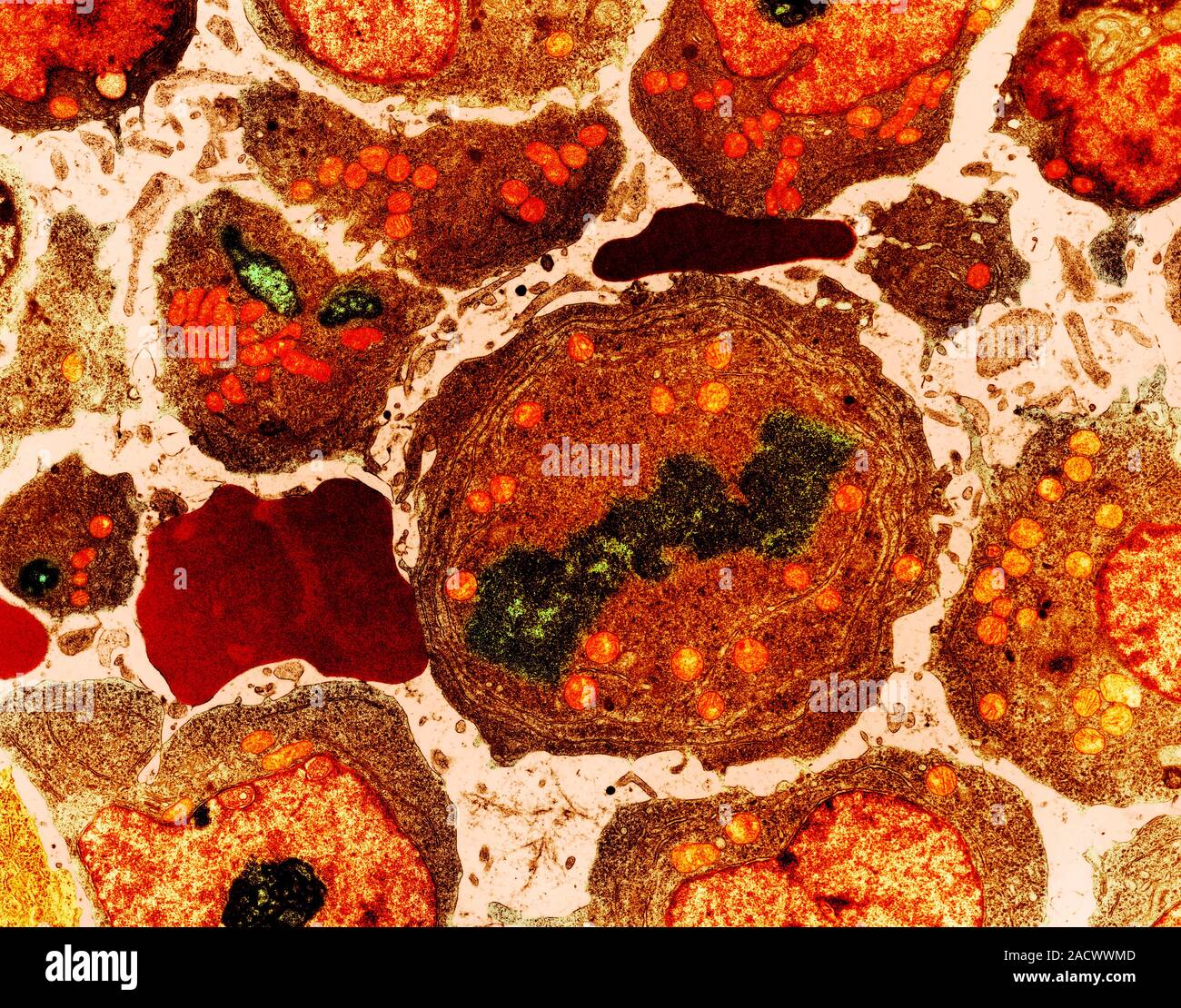Cellula plasmatica del cancro. Colorato micrografia elettronica a ...