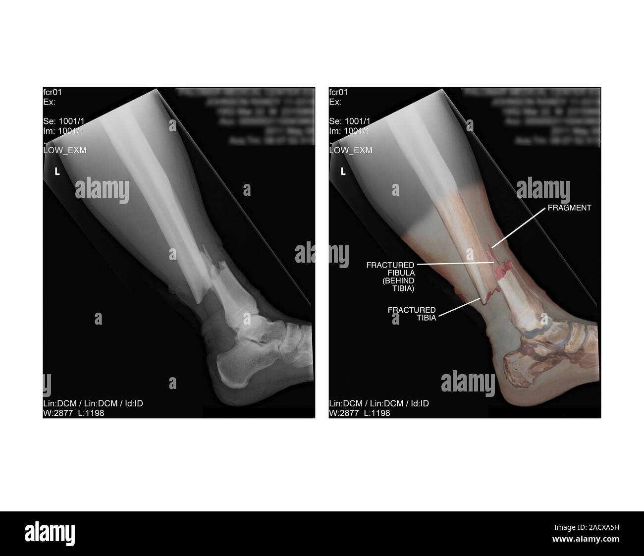 Tibia E Perone Etichettati POLITECNICO DI TORINO