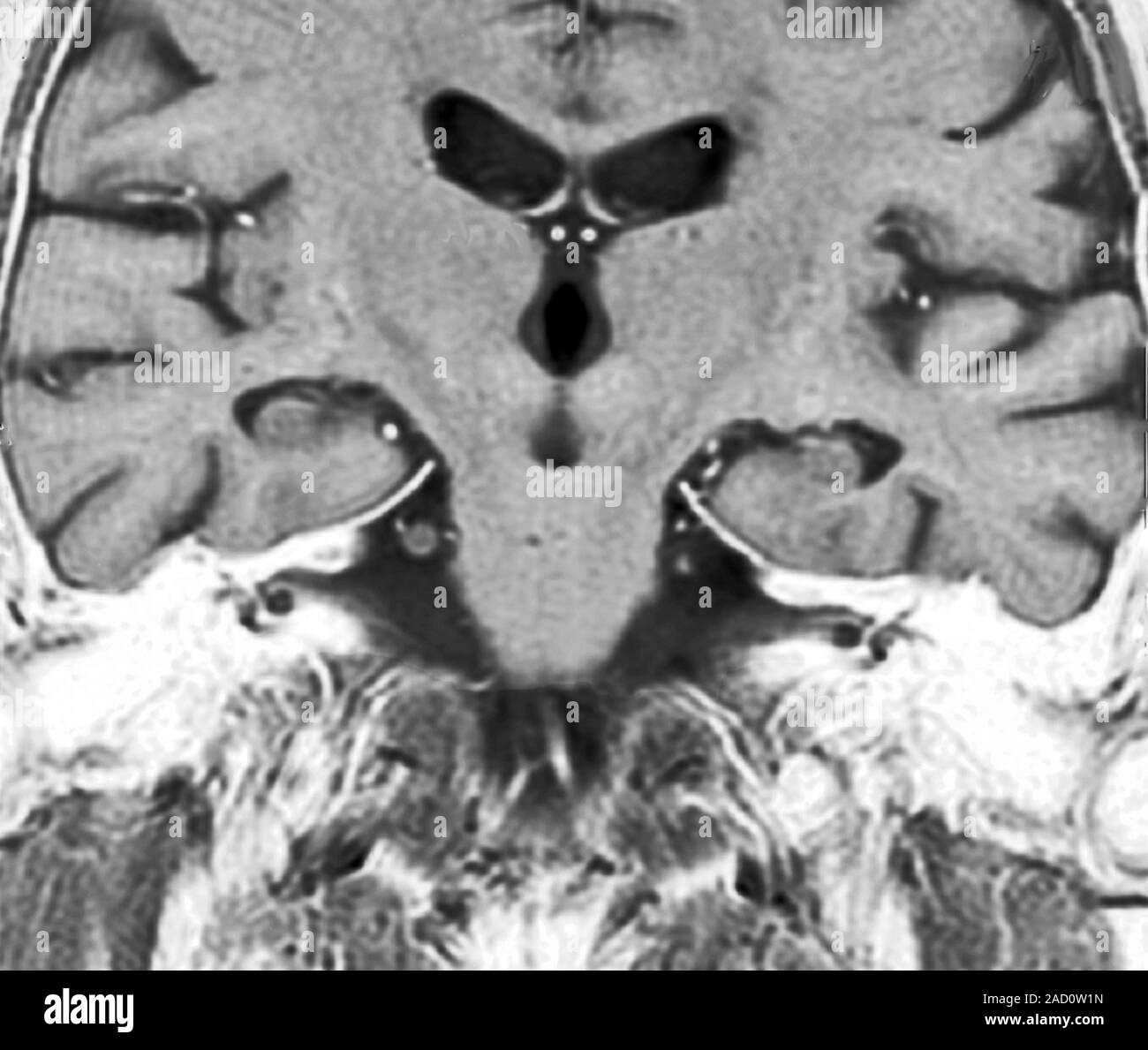 Cervello e hippocampus. Imaging a risonanza magnetica (MRI) scansione ...
