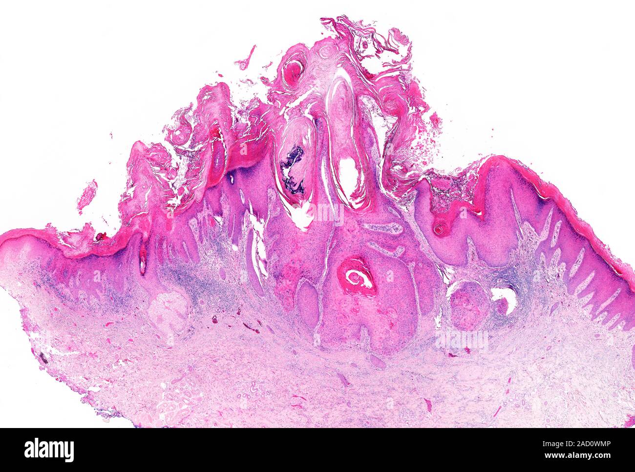 Microscopia a luce del carcinoma a cellule squamose della pelle ...