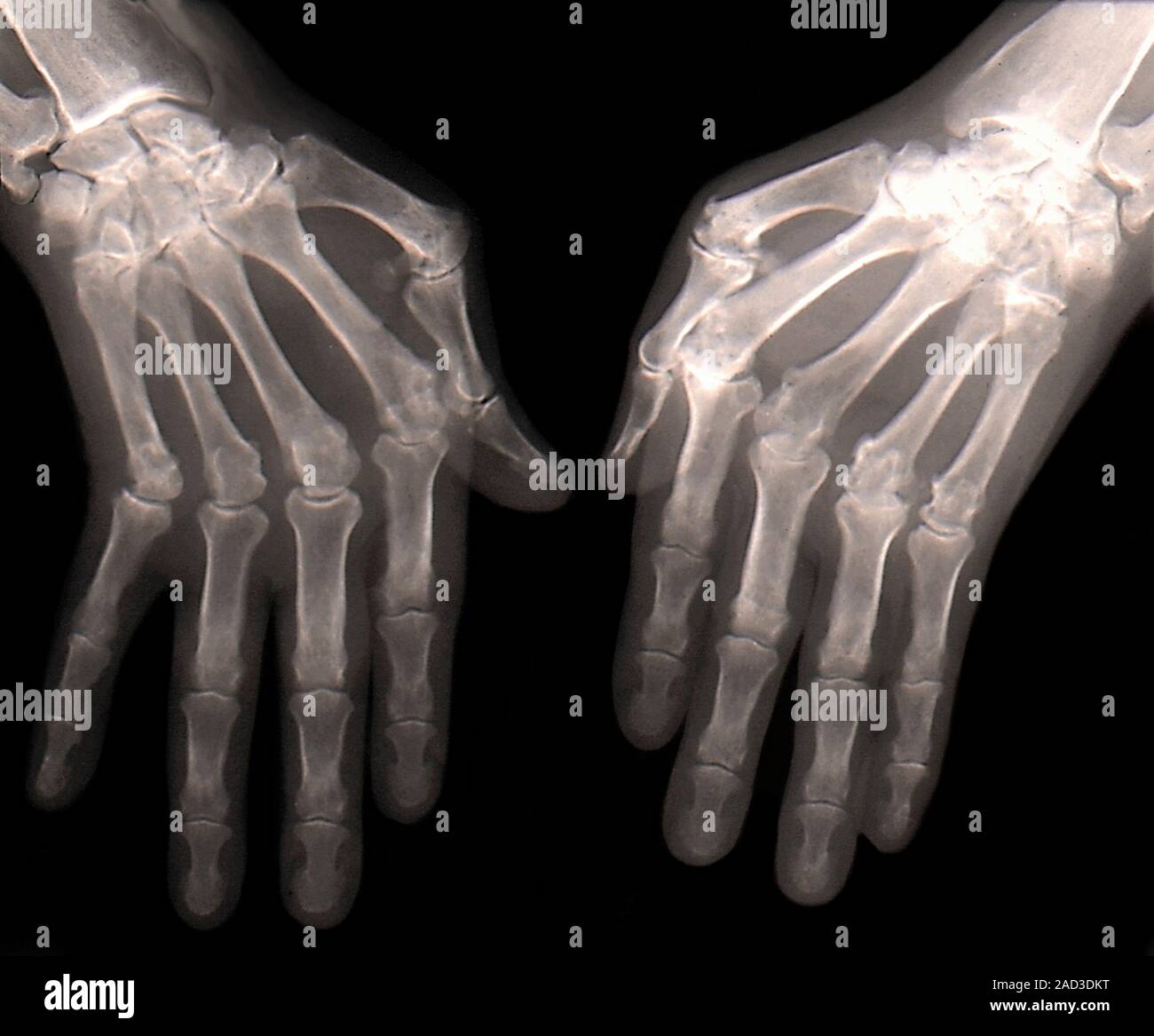 Artrite reumatoide di mani. Raggi X di una sezione attraverso le mani ...