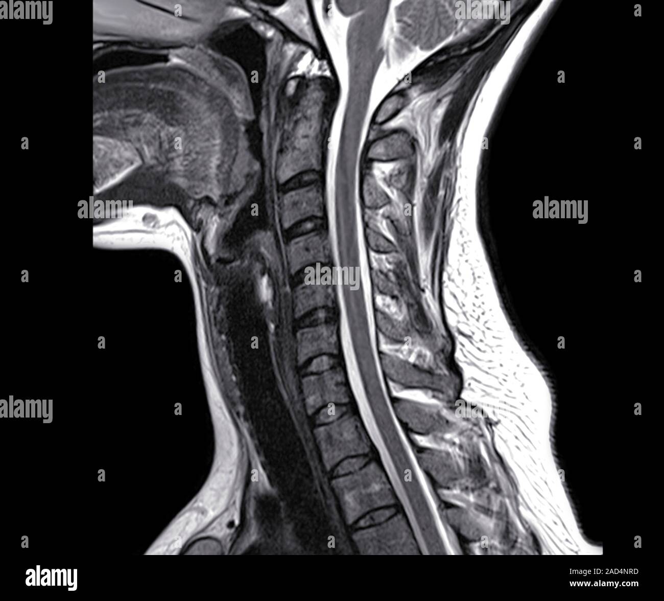 Il normale vertebra lombare. Imaging a risonanza magnetica (MRI ...