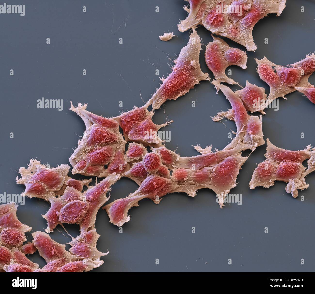 Rabdomiosarcoma alveolare cellule cancerose, colorata di ...