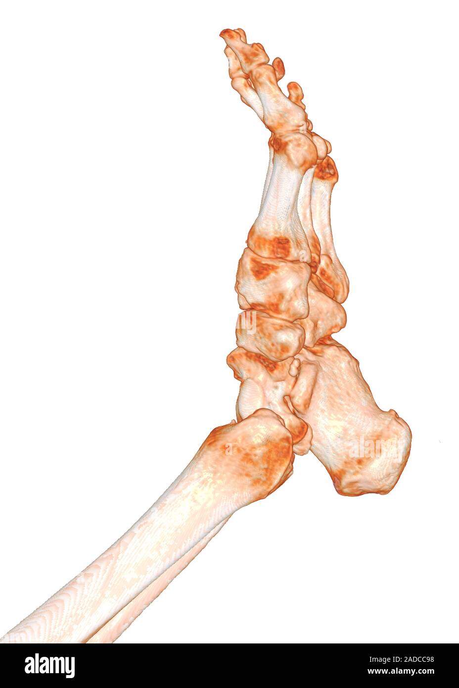 Piede umano, 3D colorato tomografia computerizzata (CT) scansione. L ...