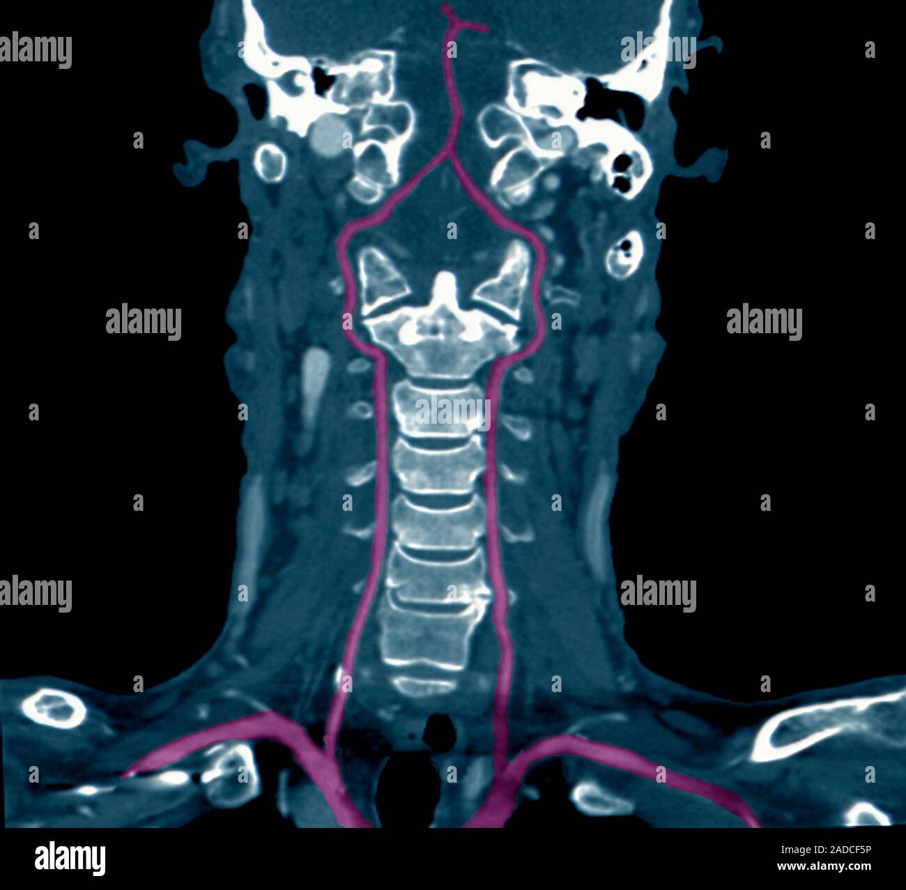 Le arterie del collo e della colonna vertebrale. Coronale colorati ...