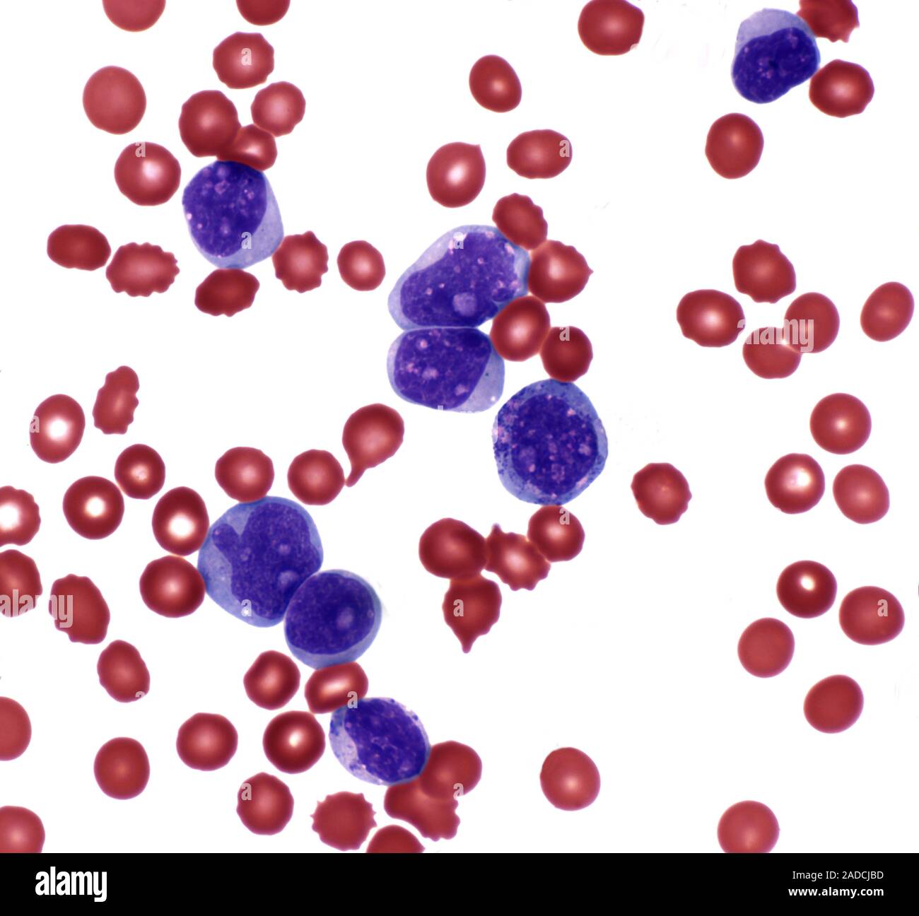 Leucemia mieloide acuta. Micrografia luce di uno striscio di sangue da ...